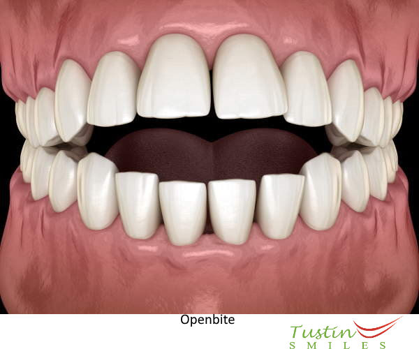 Open Bite - Symptoms, Causes and Treatment for Open Bite Malocclusion